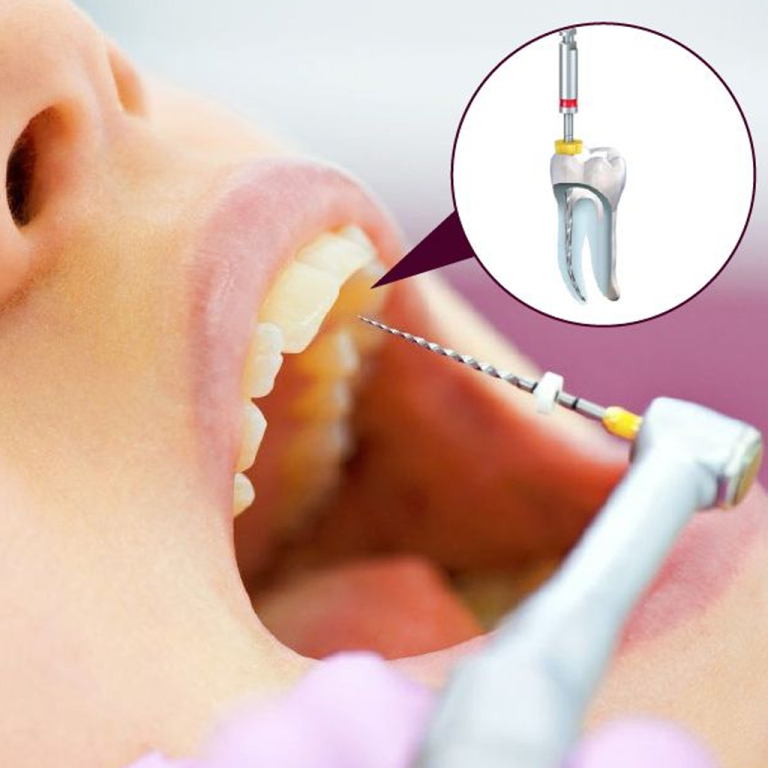 Hand vs Rotary Endodontic Instruments Difference