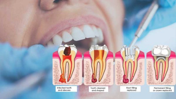 Step-by-Step Guide to Root Canal Instruments